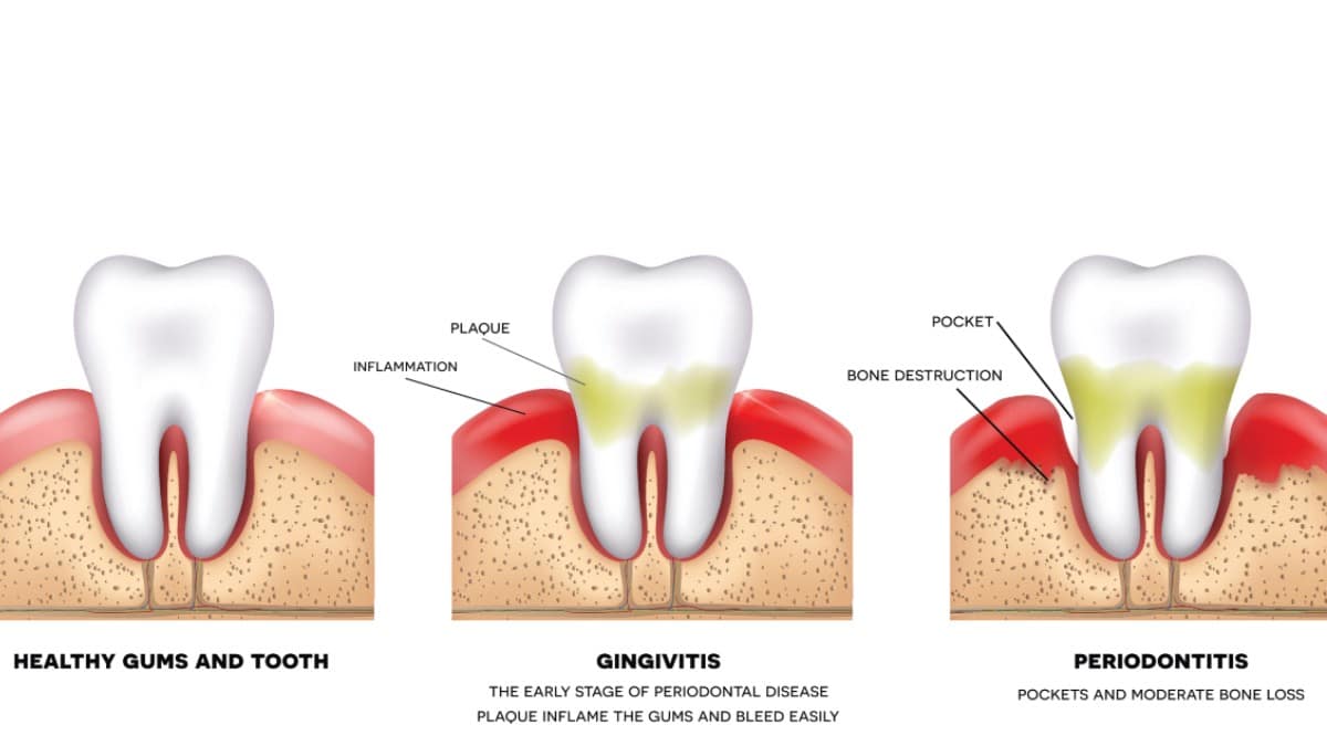 6 Tips to Stop Bleeding Gums Naturally - Dr. Nicole Mackie"